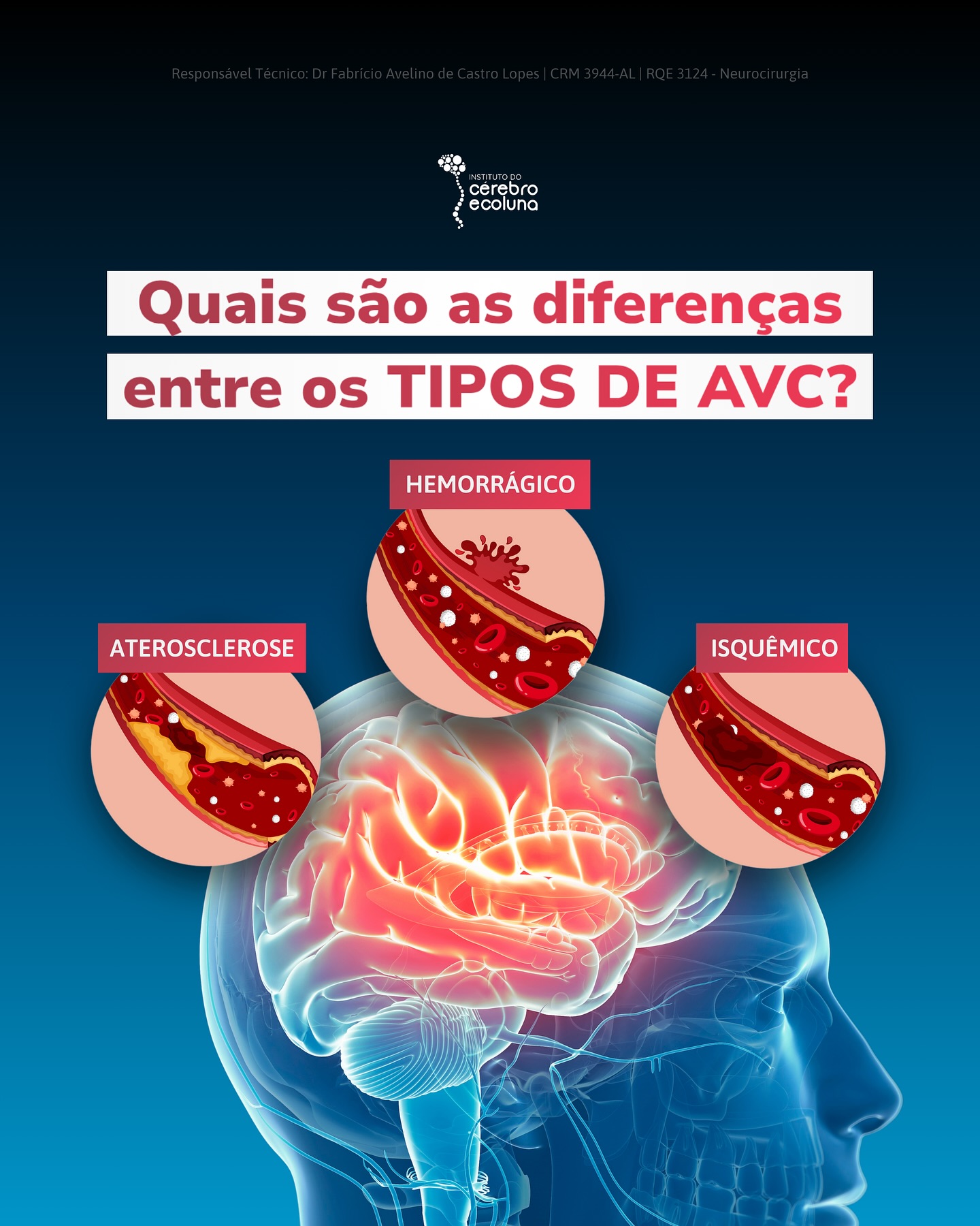 Cada tipo de AVC tem uma causa e impacto diferentes no organismo: