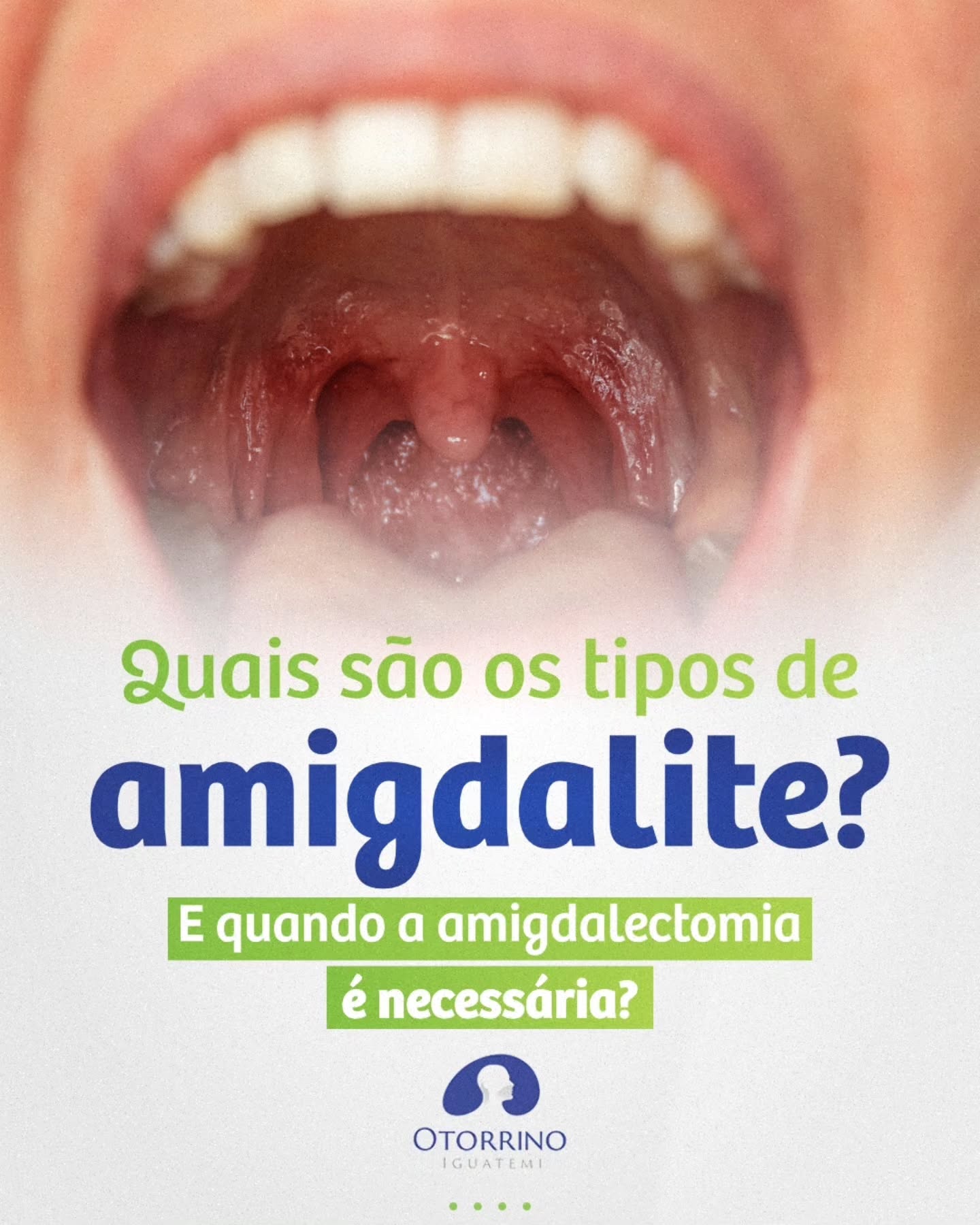 Quais são os tipos de amigdalite e como cada uma delas pode se ...