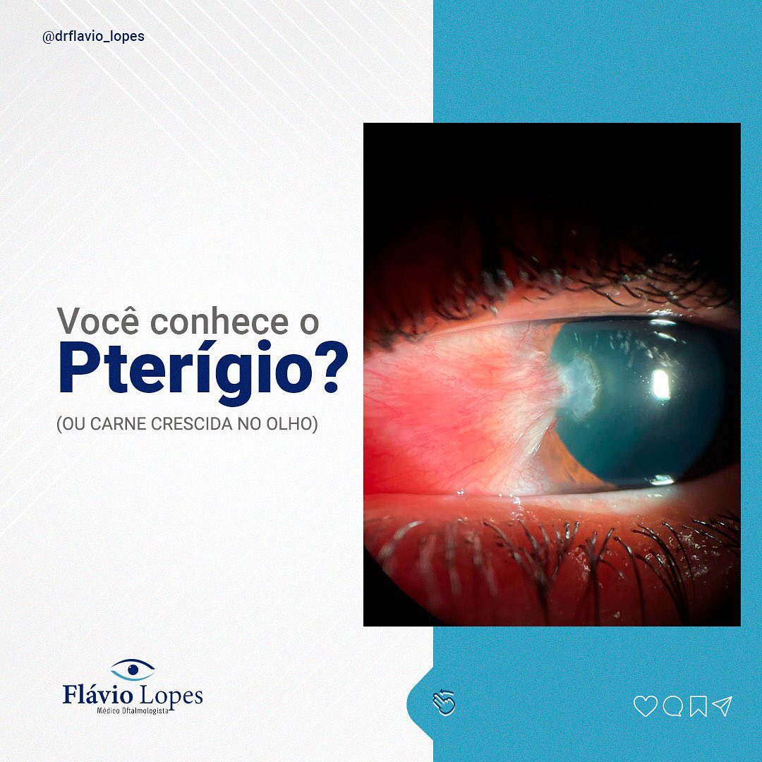Você Sabe O Que É Pterígio? , O que é pterígio? Entenda o que é e como ...