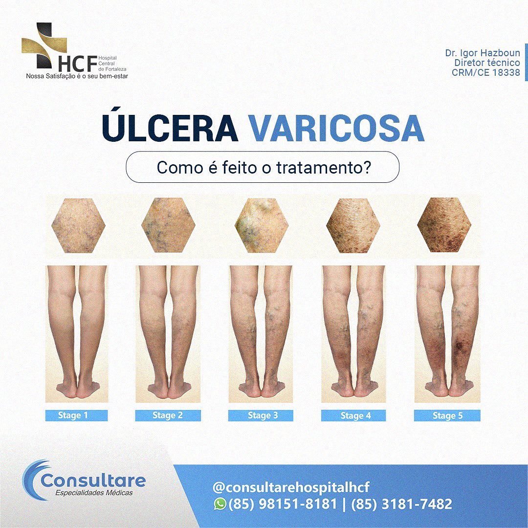 Ulcera Varicosa como é feito o tratamento.
